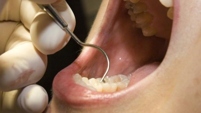 ሰዋስው | የጥርስ መቦርቦር /Tooth Decay